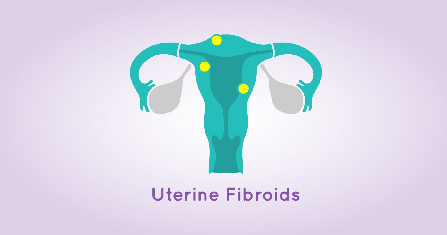 Choosing Uterine Fibroid Embolization Over a Hysterectomy