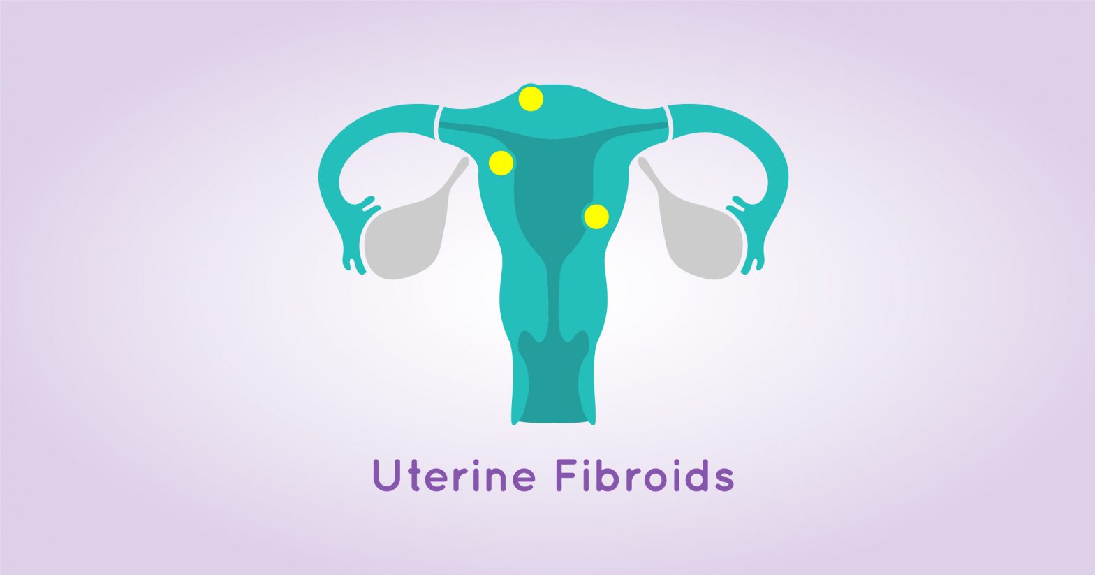 Choosing Uterine Fibroid Embolization Over a Hysterectomy